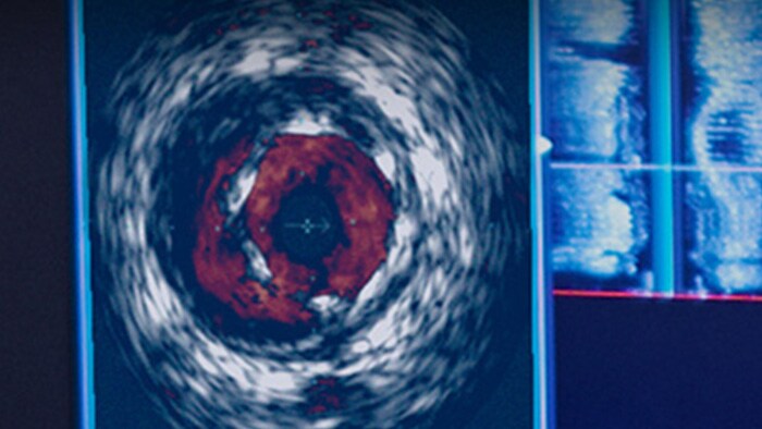 Imagerie échographique Philips Volcano ChromaFlo | Philips