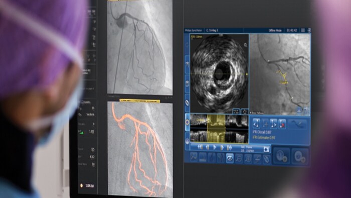 Advanced IVUS Imaging Technology | Philips Healthcare