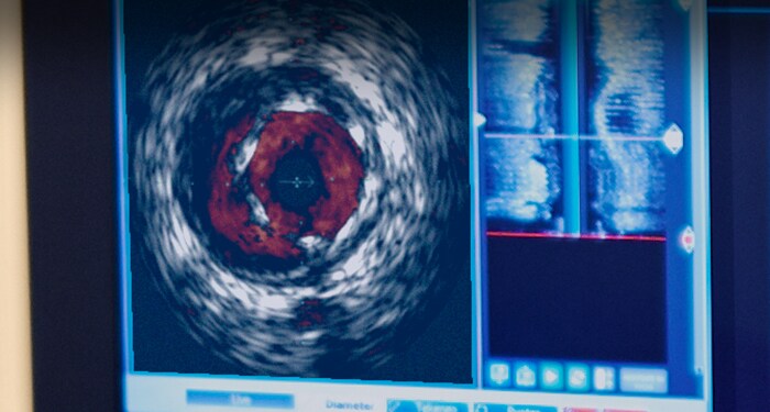 Philips Volcano ChromaFlo imaging | Philips
