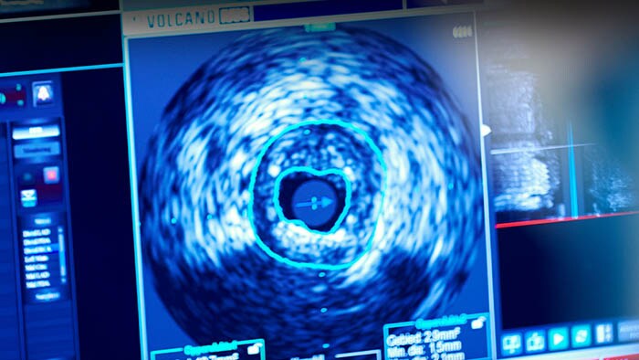 Échographie intravasculaire (IVUS) | Philips Healthcare