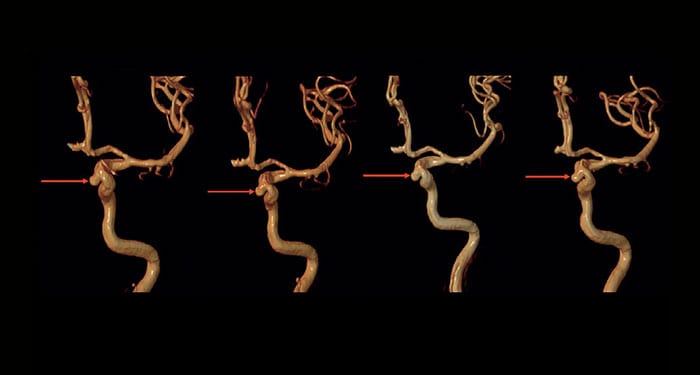 Aneurysms with 3D TOF MRA - FieldStrength MRI | Philips Healthcare