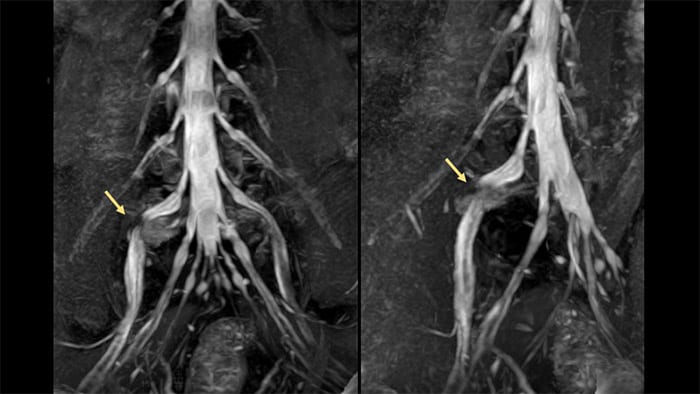 Mri Nerve Visualization Informs Surgery Fieldstrength Philips