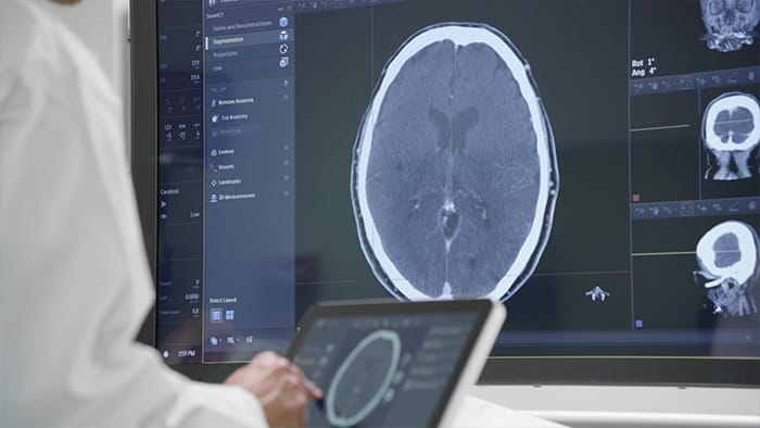 Traitement d’un accident vasculaire cérébral ischémique | Philips ...
