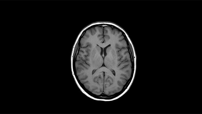 MRI Compressed Sensing - MRIソフトウェア | Philips