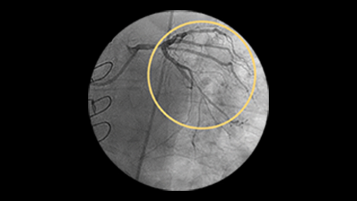 Left main disease | Philips Healthcare