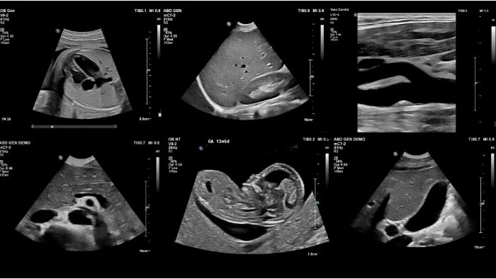Noise-Free XRES Ultrasound Imaging | Philips Ultrasound