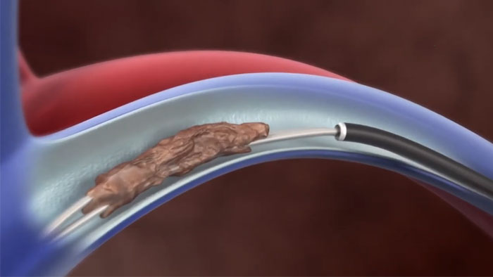 Lead Extraction for CIED Patients - Take the Lead | Philips