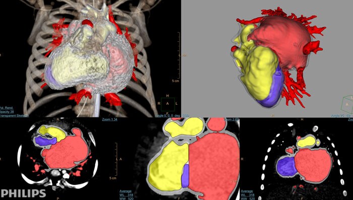 Philips unveils IntelliSpace Portal 10 with new 3D modeling application ...