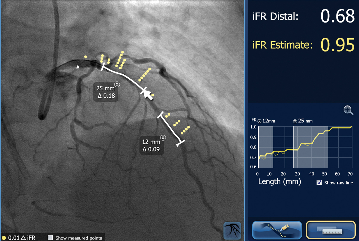 DEFINE PCI study residual ischemia - News | Philips