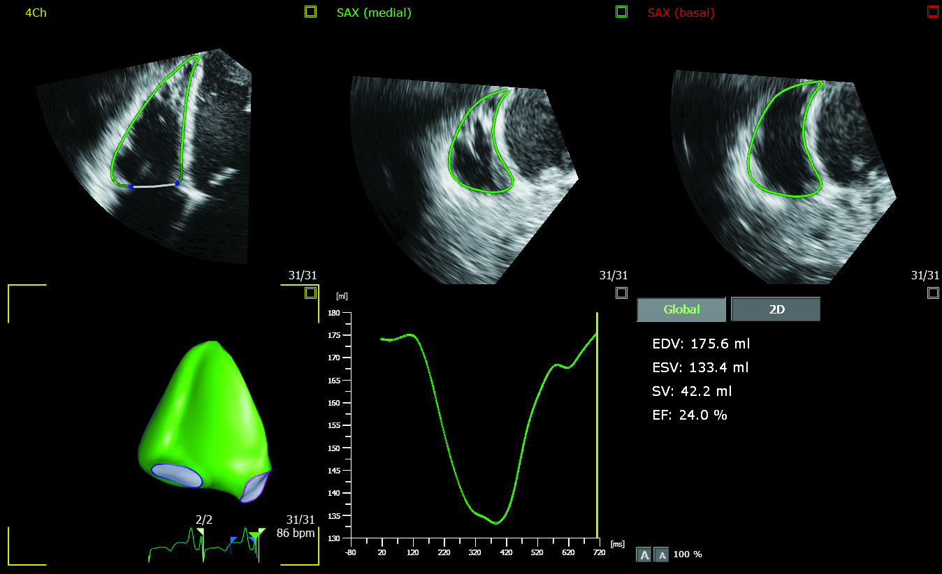 New automation capabilities for Philips EPIQ CVx cardiology ultrasound ...