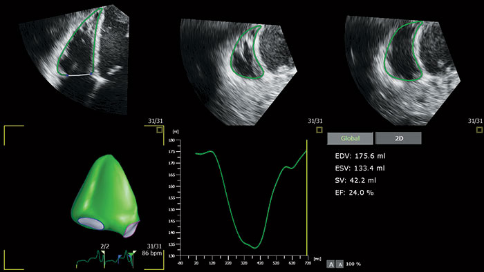 New automation capabilities for Philips EPIQ CVx cardiology ultrasound ...