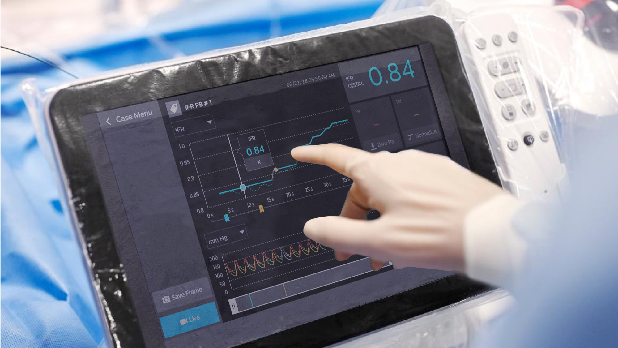 Next generation Azurion image-guided therapy platform - News | Philips