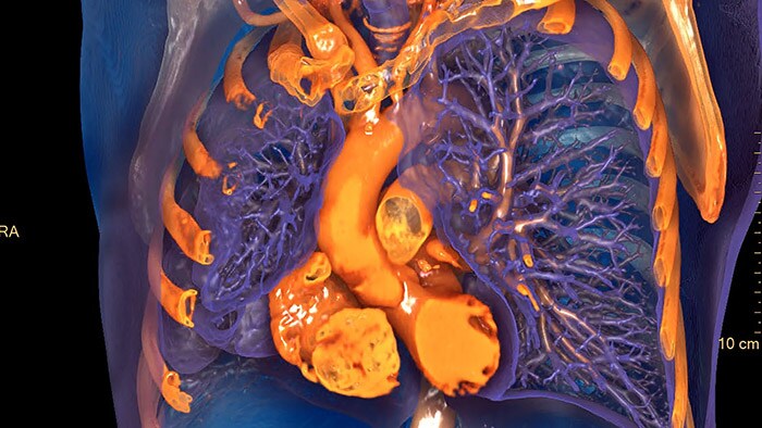 Philips Live! at RSNA 2020 - News | Philips