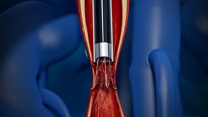 FDA clearance Philips IVC filter removal solution - News | Philips