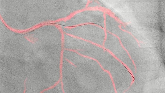 Philips Dynamic Coronary Roadmap - News | Philips